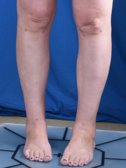 Thigh Liposuction Denver, Colorado | ABS Institute